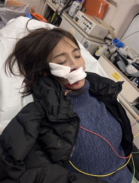 F級av女優爆毀容！「臉縫13針」驚悚照曝光：沒把握復原 娛樂星聞