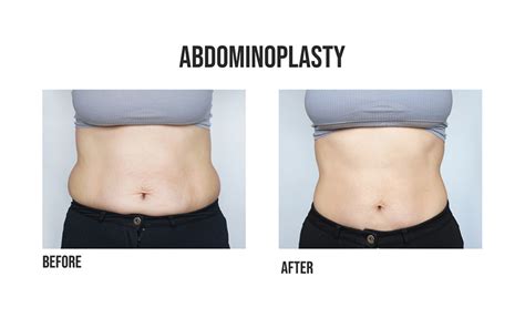 The Role Of Abdominal Boards After Tummy Tuck
