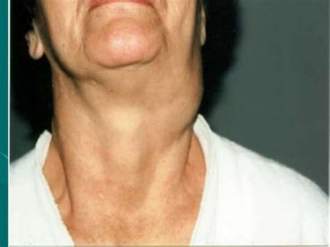 Differential Diagnosis Of Neck Massppt