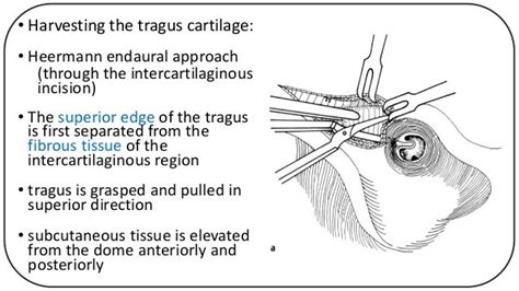 Technique Of Harvesting Cartilage Graft For Cartilage Tympanoplasty