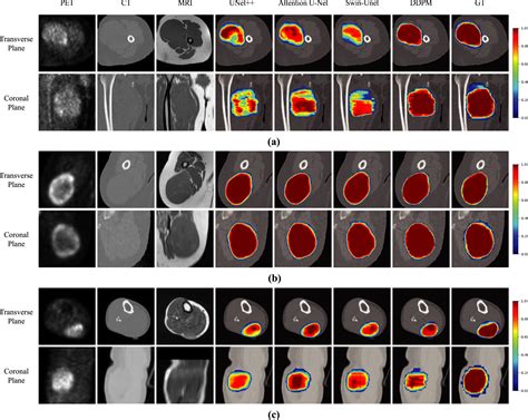 Gross Tumor Volume Confidence Maps Prediction For Soft Tissue Sarcomas From Multi Modality