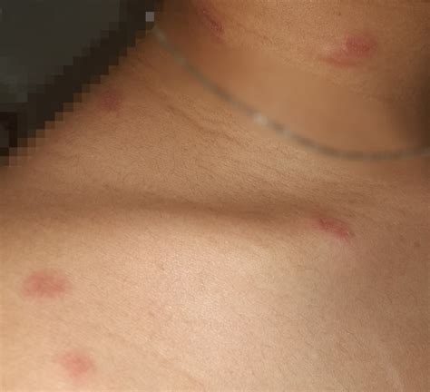 เลี้ยงแมวอายุ 1 เดือน 16 วัน 3 4วันก่อน ขึ้นตุ่มแดง มีใครพอรู้ไหมว่า