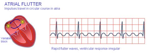 Difference Between Typical And Atypical Atrial Flutter Wasprices