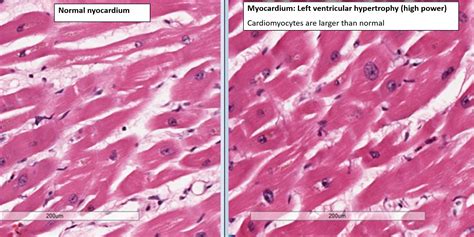 Pathological Hypertrophy Heart Diagram Richkery