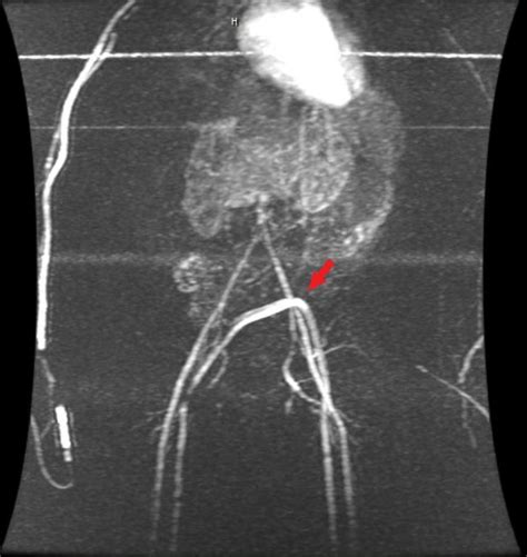 Magnetic Resonance Venogram Demonstrating An Anomalous Abdominal Venous