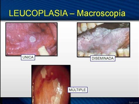 Leucoplasia Revision