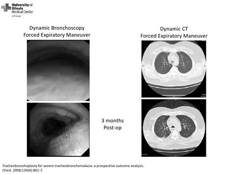 Dynamic Central Airway Obstruction Tracheomalacia Tracheobronchomal