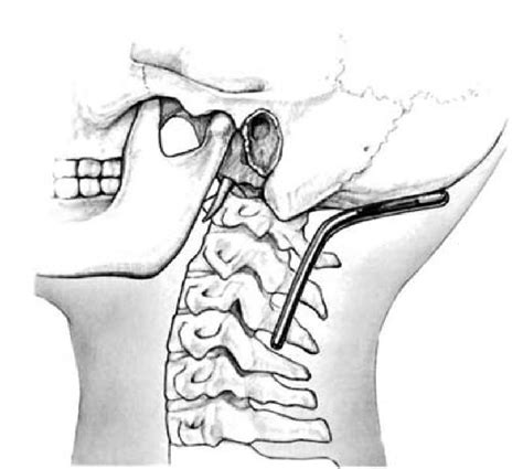 图15 24 手术的目的 脊柱手术技术