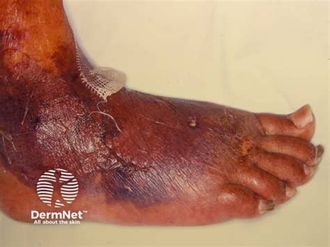 Cellulitis Mimics