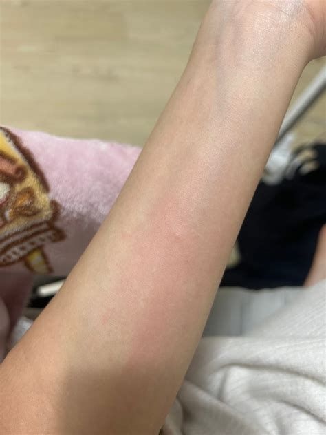 집벌레한테 물린건가요 벌레 같은게 물려요 지식in