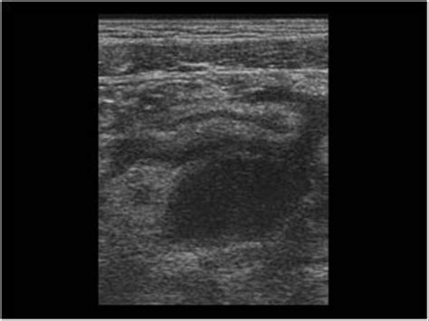 Abdomen And Retroperitoneum 15 Appendix Case 156 Post