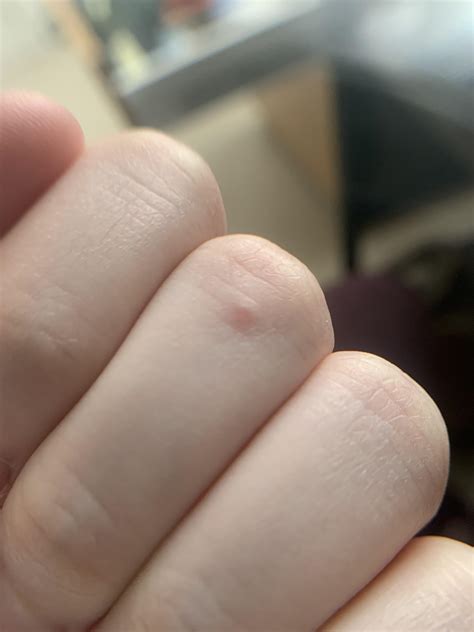 Layers Of Skin On Knuckle At Angeline Barron Blog