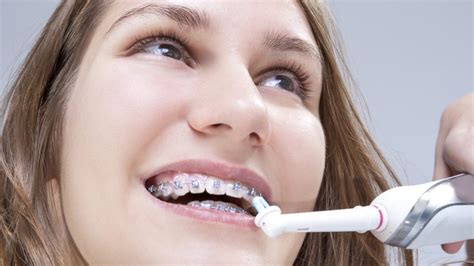 مراقبت‌های بعد از ارتودنسی دندان مخاطب