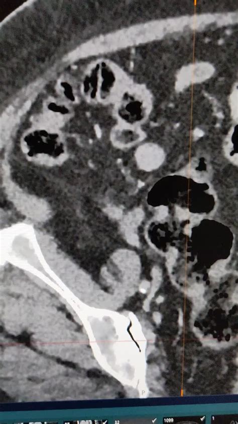 Uncommon Ingested Foreign Body Rradiology