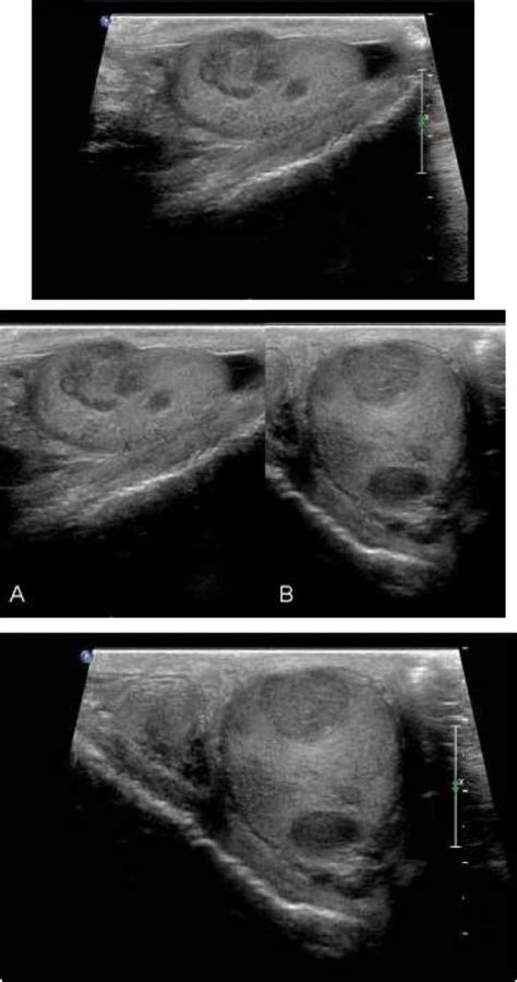 Scrotal Ultrasound Of Left Testis Ultrasound Reveals Multiple