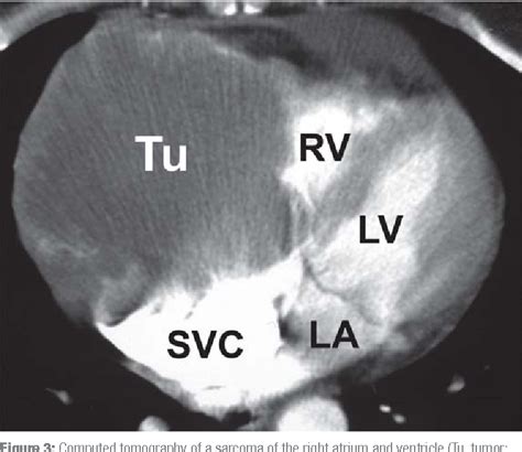 Cardiac Sarcoma Semantic Scholar