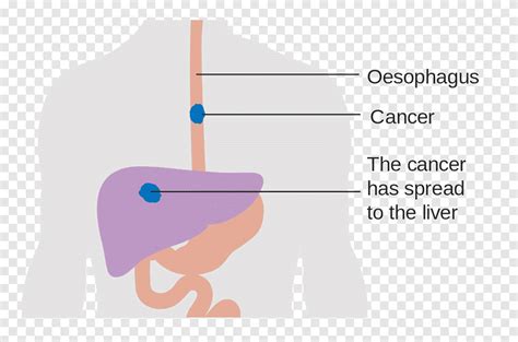 Kanker Kerongkongan Penyakit Disophagia Esofagus Basal Bermacam Macam