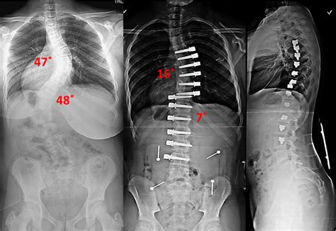 Scoliosis X Ray With Rods Harrington Rod For Scoliosis Complications