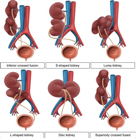 Congenital Anomalies Of The Upper Urinary Tract A Comprehensive