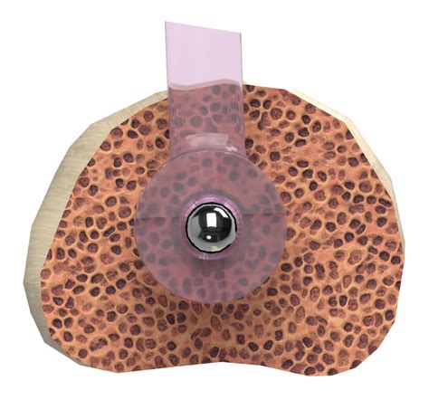 Nextra® Ch Cannulated Hammertoe Correction Zimmer Biomet