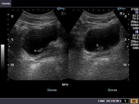 Cochinblogs Urinary Bladder Polyp