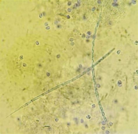 Dirofilaria Immitis Microfilariae Modified Knotts Test Magnification
