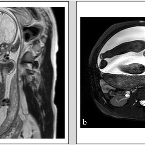 A Abdominal Plain Radiography Shows The Dilated Upper Jejunum B