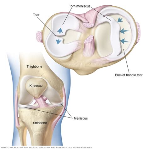 Torn Meniscus Symptoms And Causes Mayo Clinic