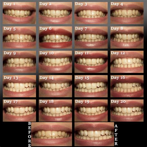 Teeth Whitening At Home With 3d Crest Whitestrips