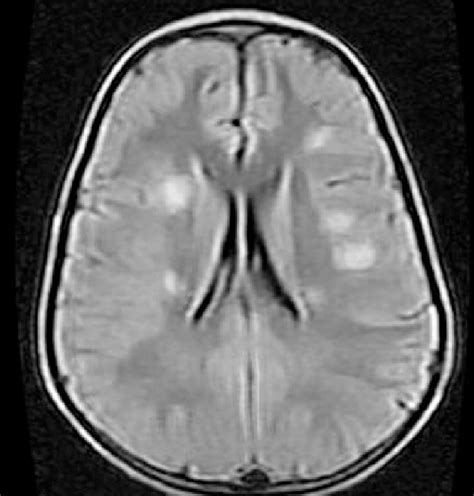Diffuse Brain Swelling With Significant White Matter Hyperintensities
