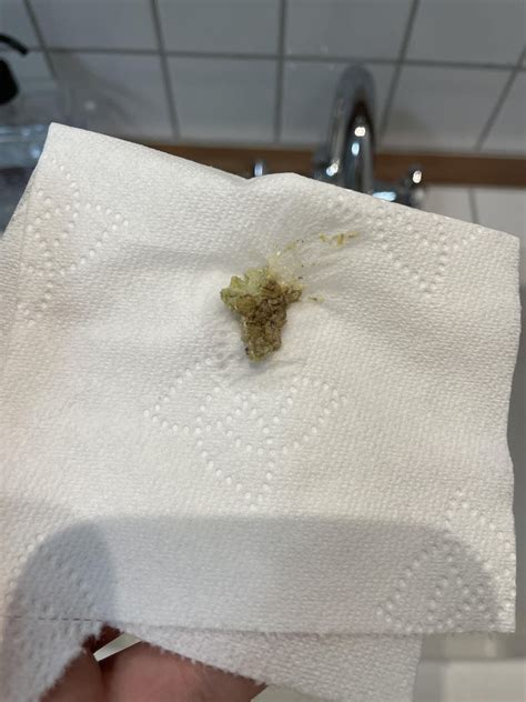 Tonsillectomy Scabs Just Finally Came Out Today Rpopping