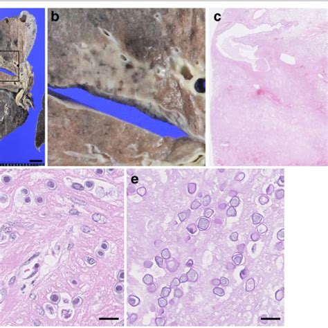 Cytological Findings Of Group 1 Acanthamoeba In Csf A And B Giemsa