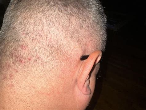 Folliculitis R Scalppsoriasis