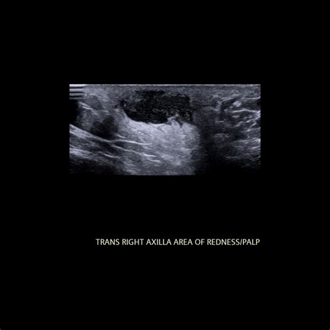 Pediatric Subcutaneous Abscess Pediatric Radiology Reference Article