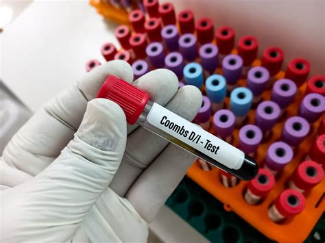 High Grades Of Dat May Predict Severe Anemia In Patients With Aiha