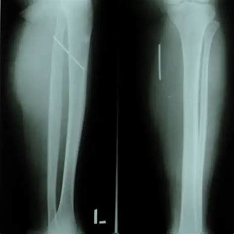 X Ray Both Leg Ap And Lat Test Price In Delhi Ganesh Diagnostic