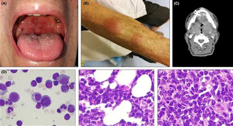 Bilateral Tonsillar Infiltration Of T‐cell Prolymphocytic Leukemia
