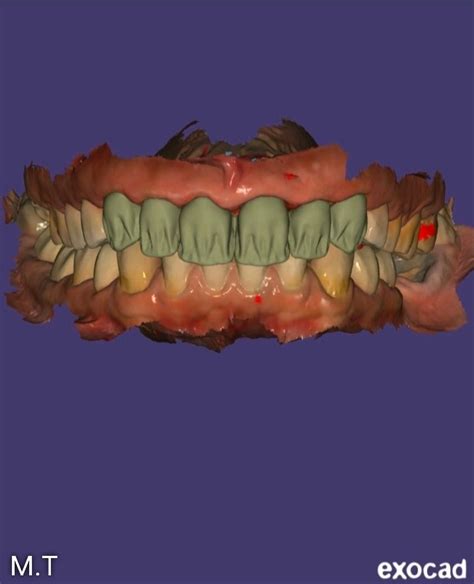 Takoua Mechergui On Linkedin Exocad 3shapedesign