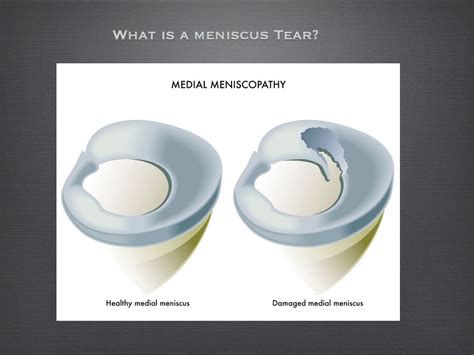 Posterior Horn Medial Meniscus Tears Howard Luks Md