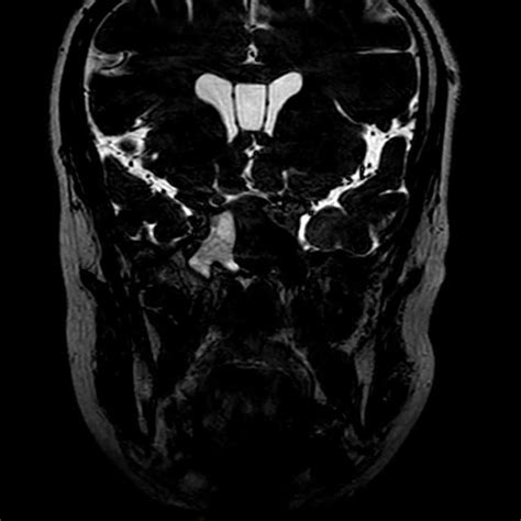 Ct Of Paranasal Sinuses Showing Opacification Of Right Sphenoid Sinus