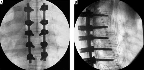Guide Wire Displacement In Robot Assisted Spinal Pedicle Screw Implantation