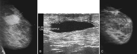 Breast Cancer Treatment Related Imaging And The Postoperative Breast