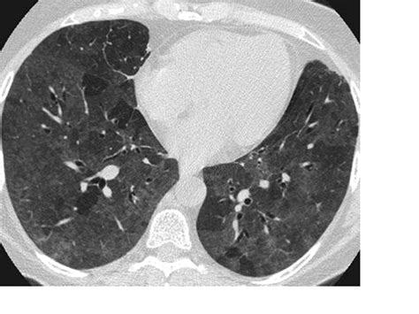 Hypersensitivity Pneumonitis Hp Lungs