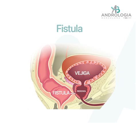 Treatment For Fistulas Ab