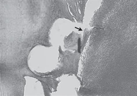 control coil 6 weeks after implantation there is a measurable