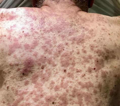 What Does An Hiv Rash Look Like