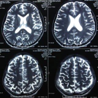 MRI Brain Showing Diffuse Cerebral Atrophy Download Scientific Diagram