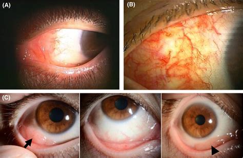 Examples Of Gross Morphologic Views Of Conjunctival Lesions A A