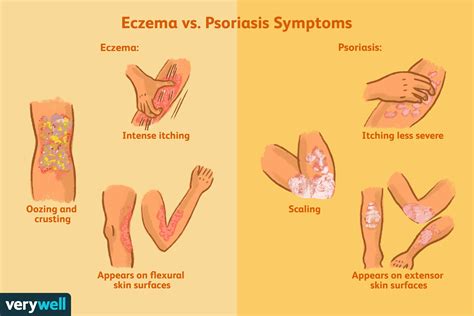 Wat Is Het Verschil Tussen Eczeem En Psoriasis Vergelijking En Symptomen