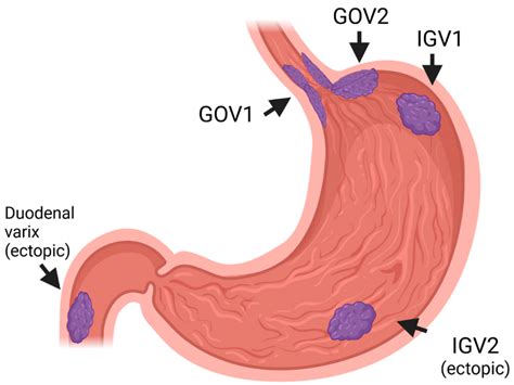 Endoscopic Classification Of Gastric Varices According To Sarin